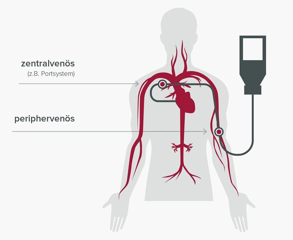 Parenterale Ernährung: Zufuhr direkt in die Vene